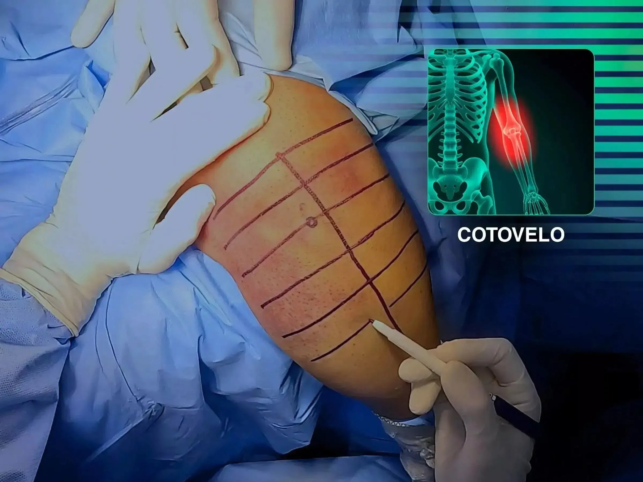 Elbow Fracture-Dislocation: Pull-Out Technique and Reconstruction