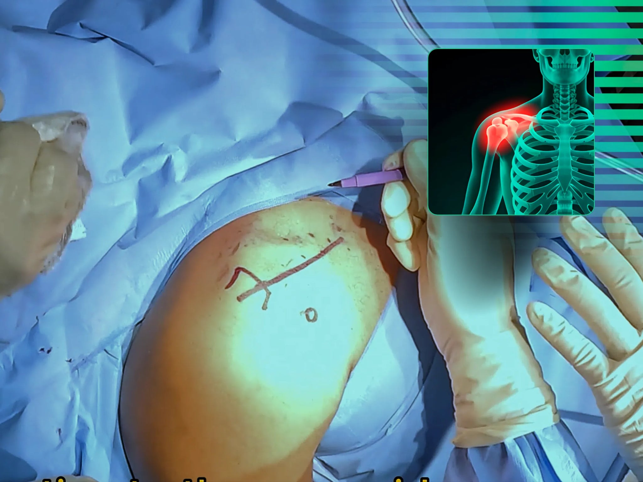 Lateral Clavicle Fracture: Plate and Tissue Fixation